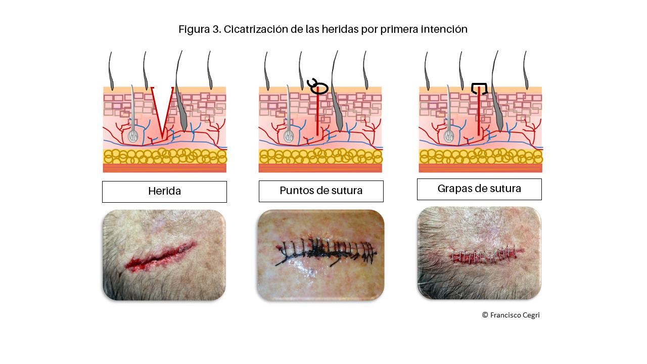 Infermeravirtual.com - Heridas y quemaduras, Problemas de salud